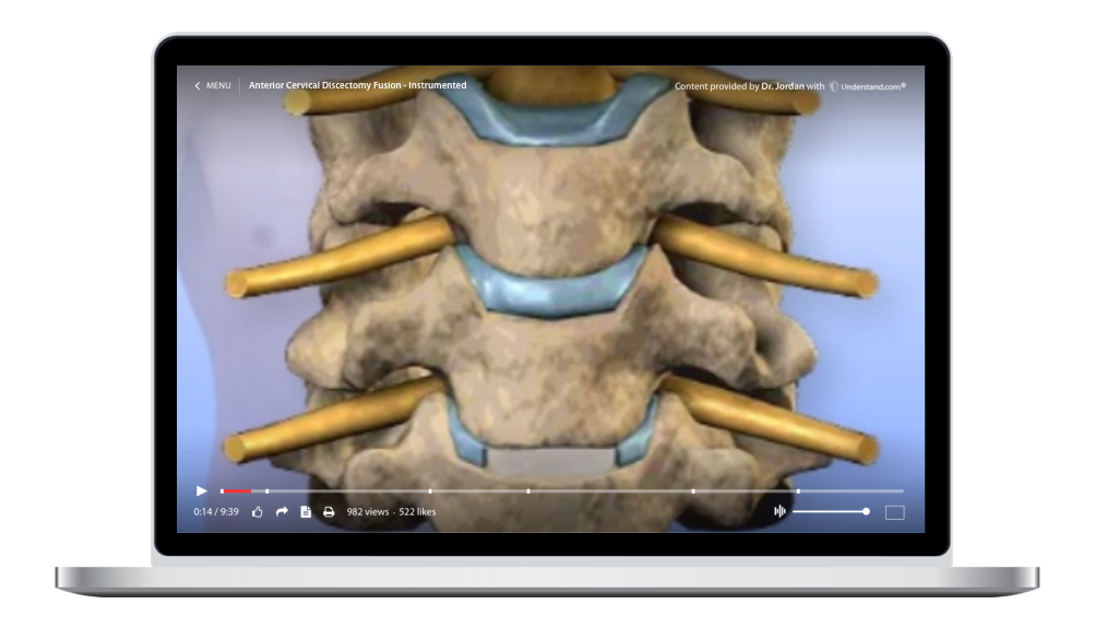 Cervical Anterior Cervical Discectomy Fusion Instrumented