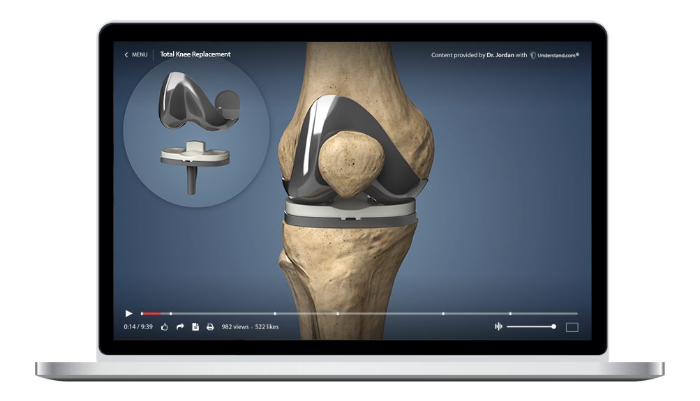 Total Knee Replacement Animation – Understand.com