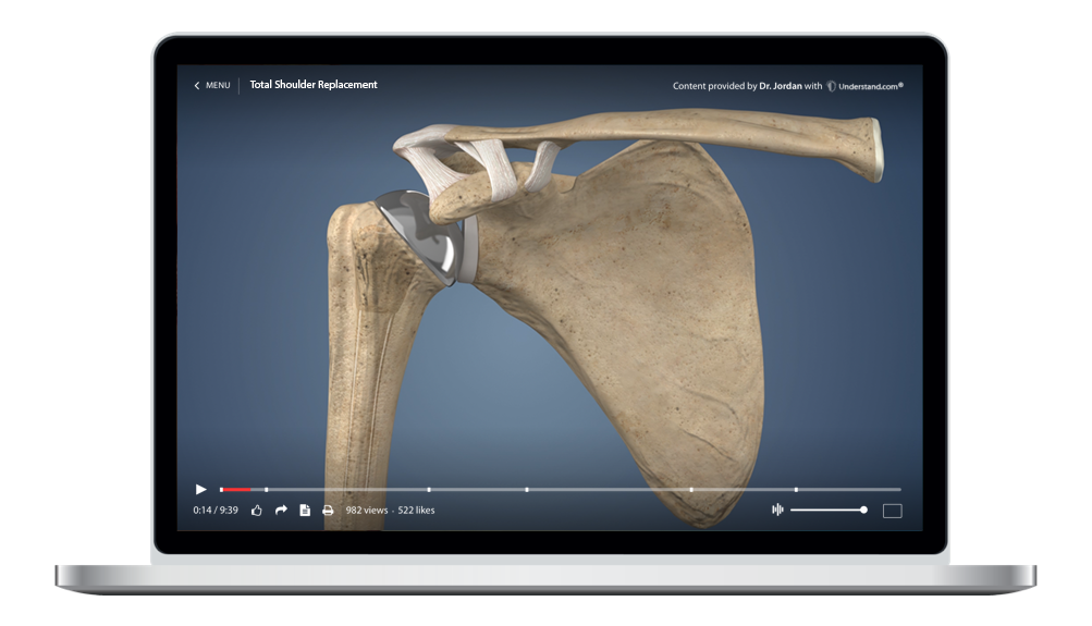 Total Shoulder Replacement Animation – Understand.com
