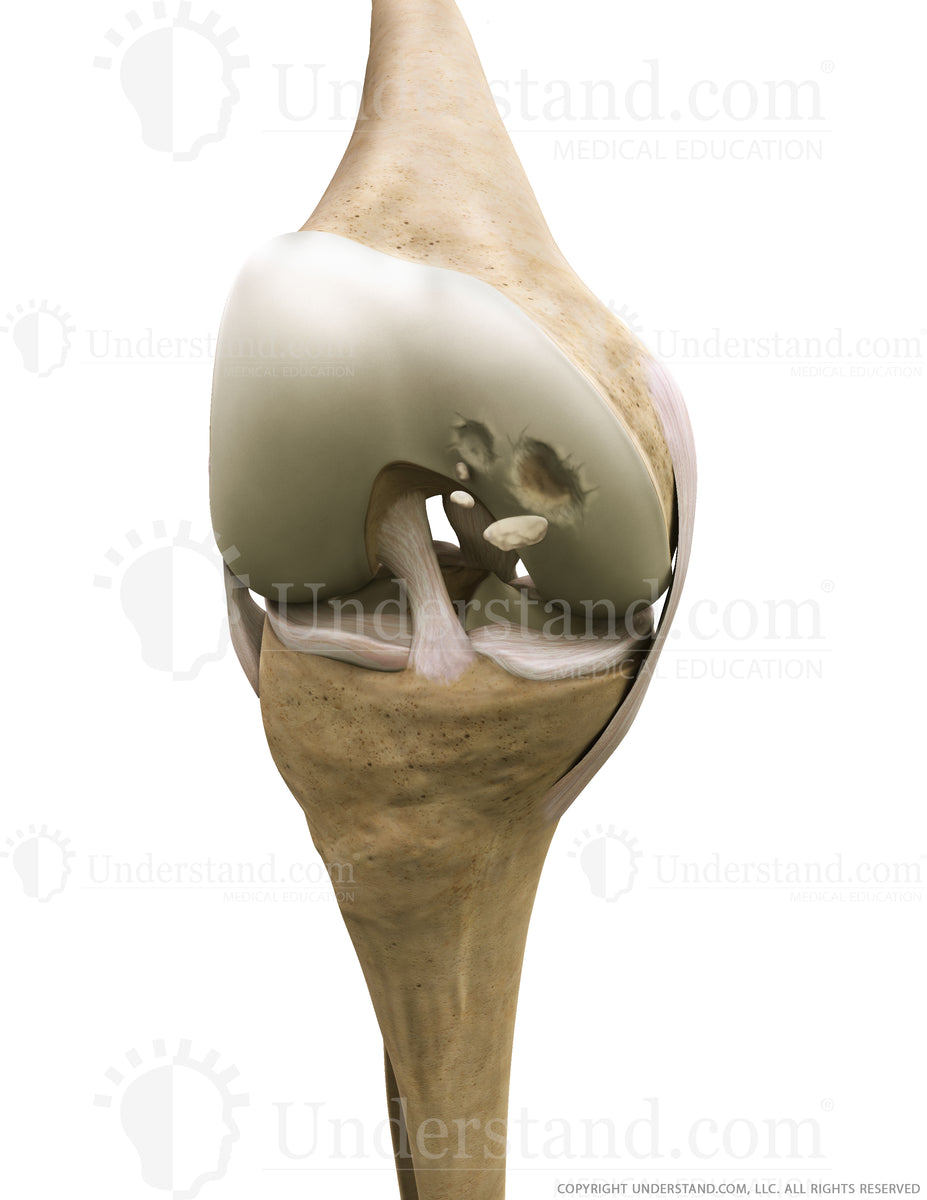 Knee Loose Bodies Anterior Flexed Image – Understand.com