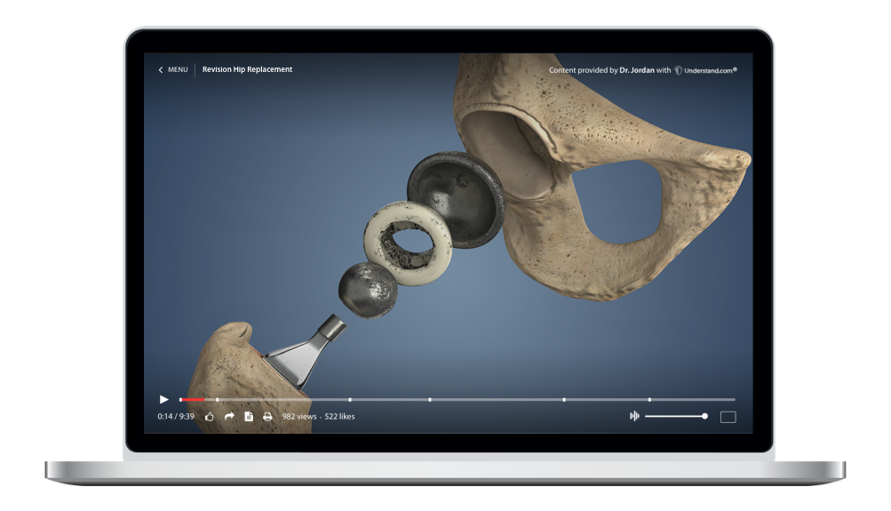 Revision Hip Replacement Animation – Understand.com