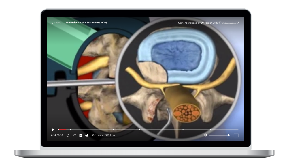 Lumbar - Minimally Invasive Discectomy (PDR) Animation – Understand.com