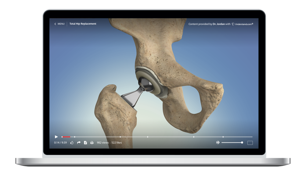 Total Hip Replacement Animation – Understand.com