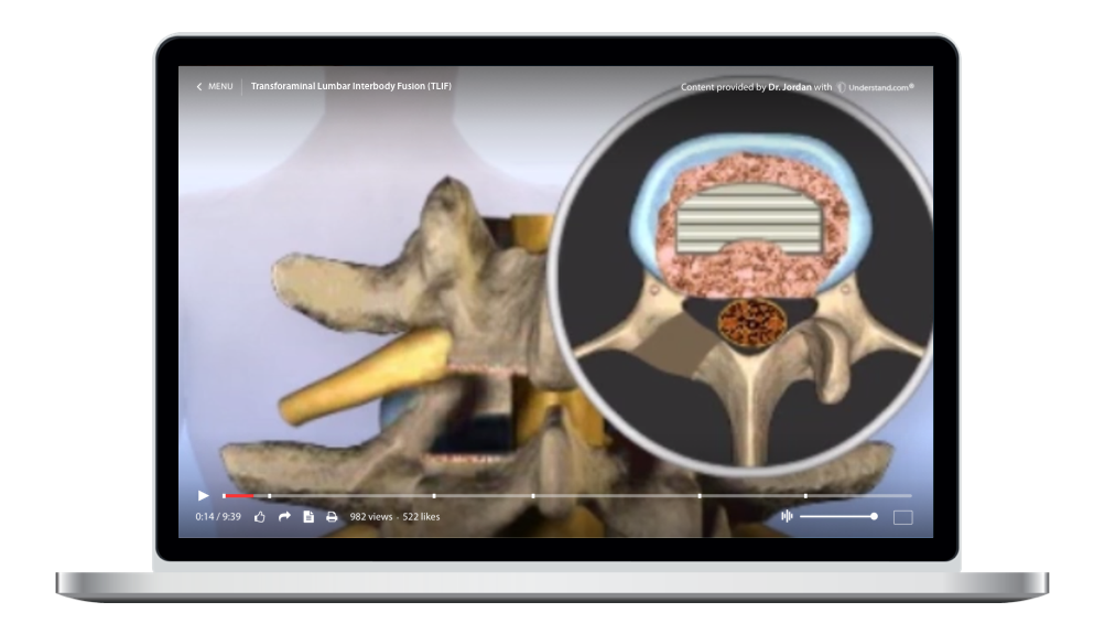 Lumbar - Transforaminal Lumbar Interbody Fusion (TLIF) Animation ...