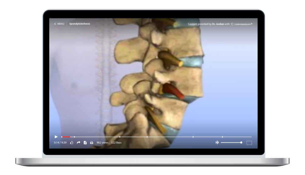 Spondylolisthesis Animation – Understand.com