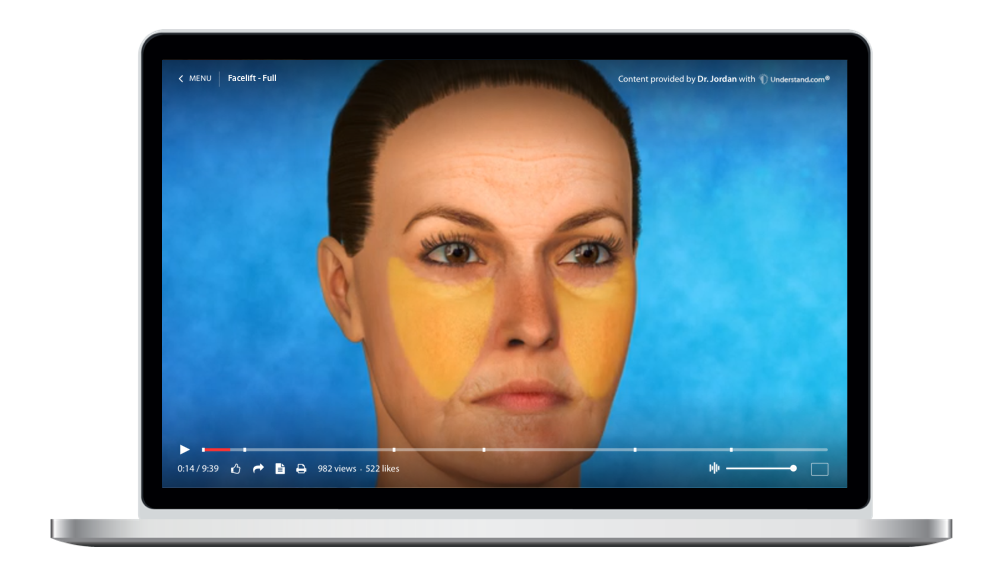 Facelift - Full Animation – Understand.com