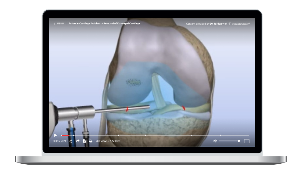 Articular Cartilage Problems - Removal of Damaged Cartilage Animation ...