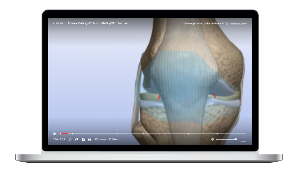 Articular Cartilage Problems - Drilling/Microfracture Animation ...
