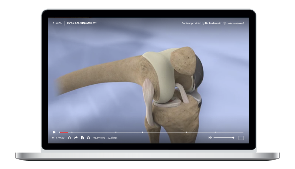 Partial Knee Replacement Animation – Understand.com