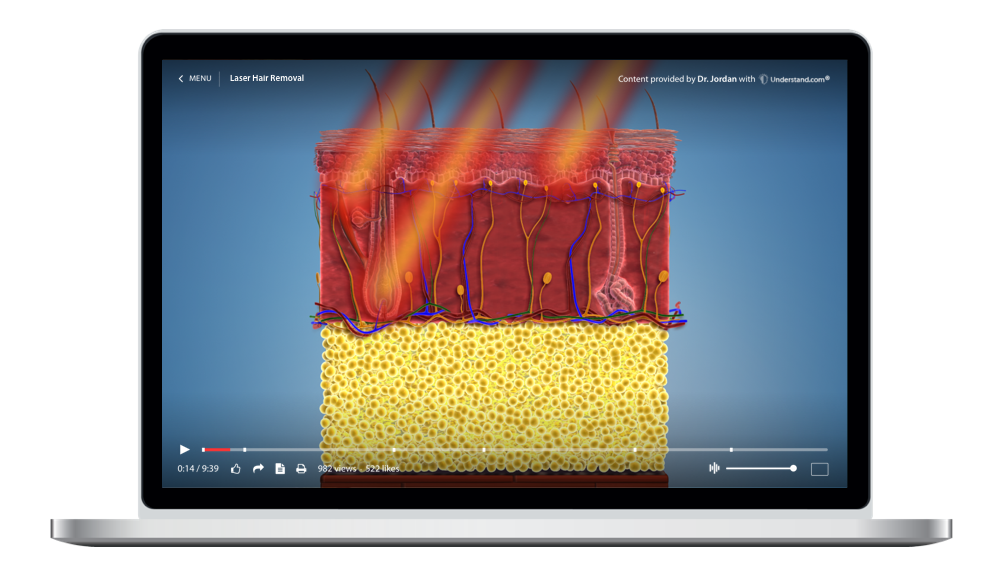 Laser Hair Removal Animation – Understand.com