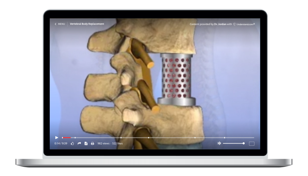 Lumbar - Vertebral Body Replacement Animation – Understand.com