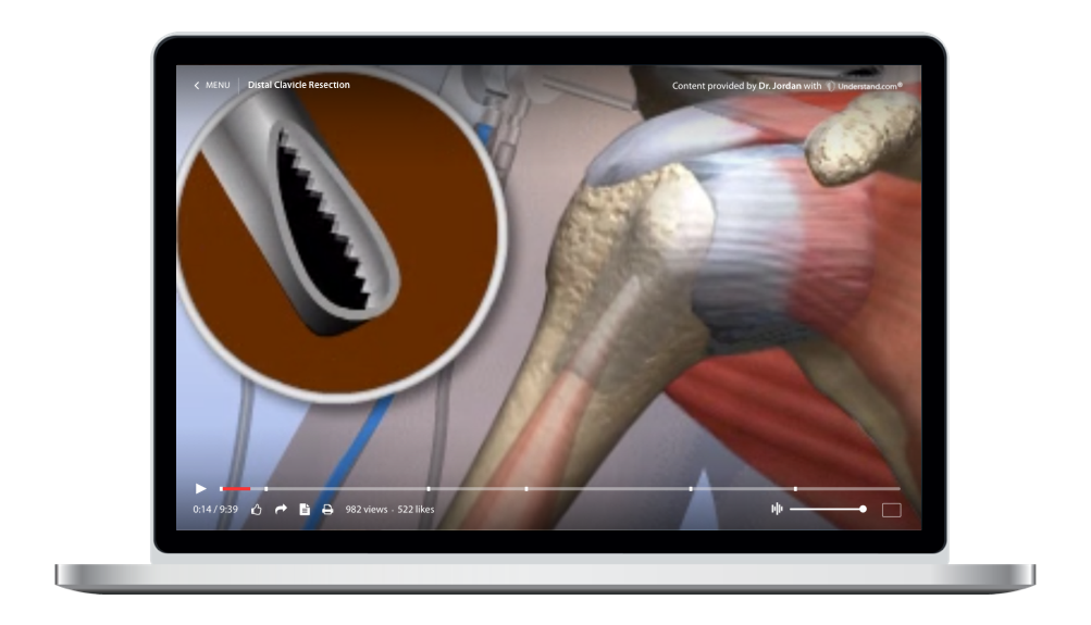 Distal Clavicle Resection Animation – Understand.com