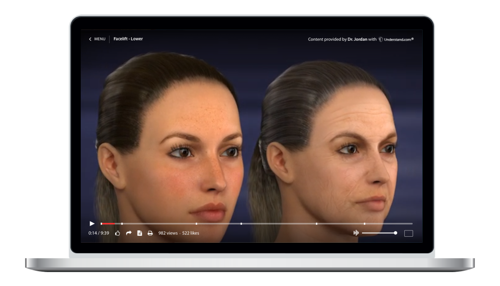 Facelift - Lower Animation – Understand.com