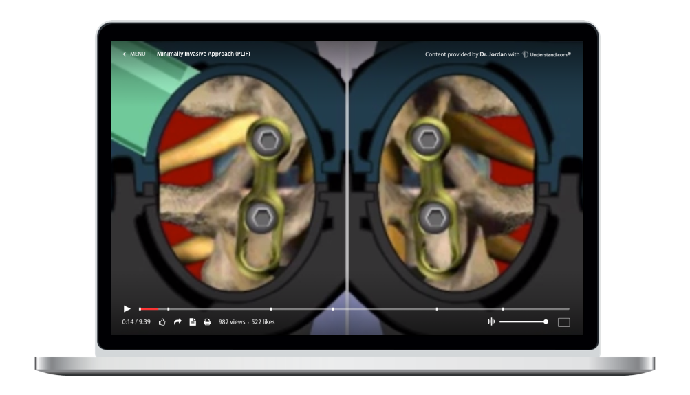 Lumbar - Minimally Invasive Approach (PLIF) Animation – Understand.com