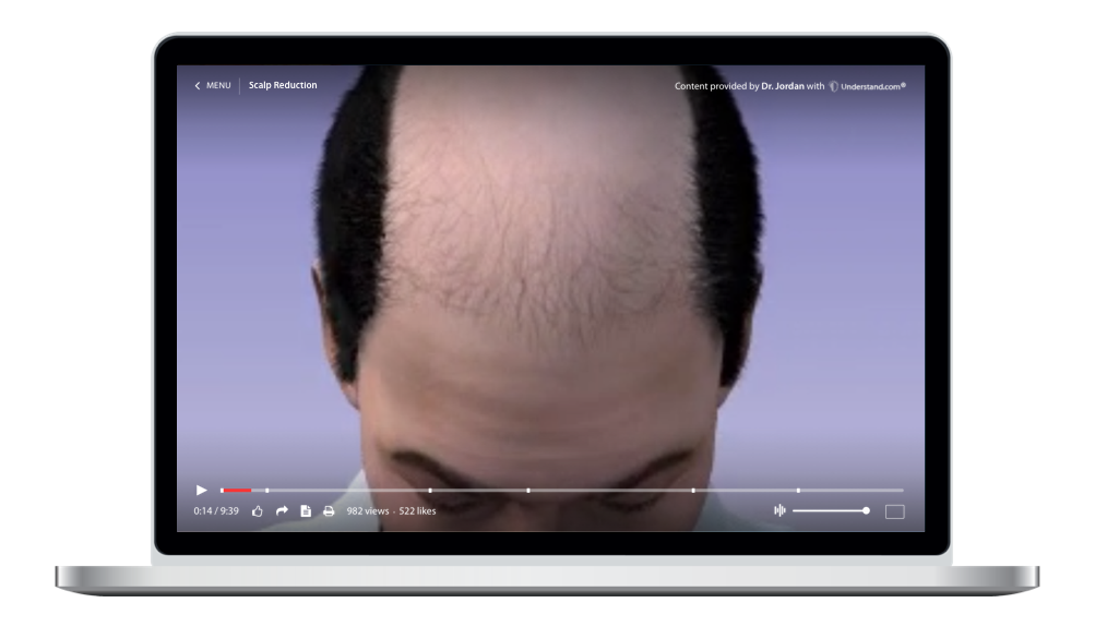 Scalp Reduction Animation – Understand.com