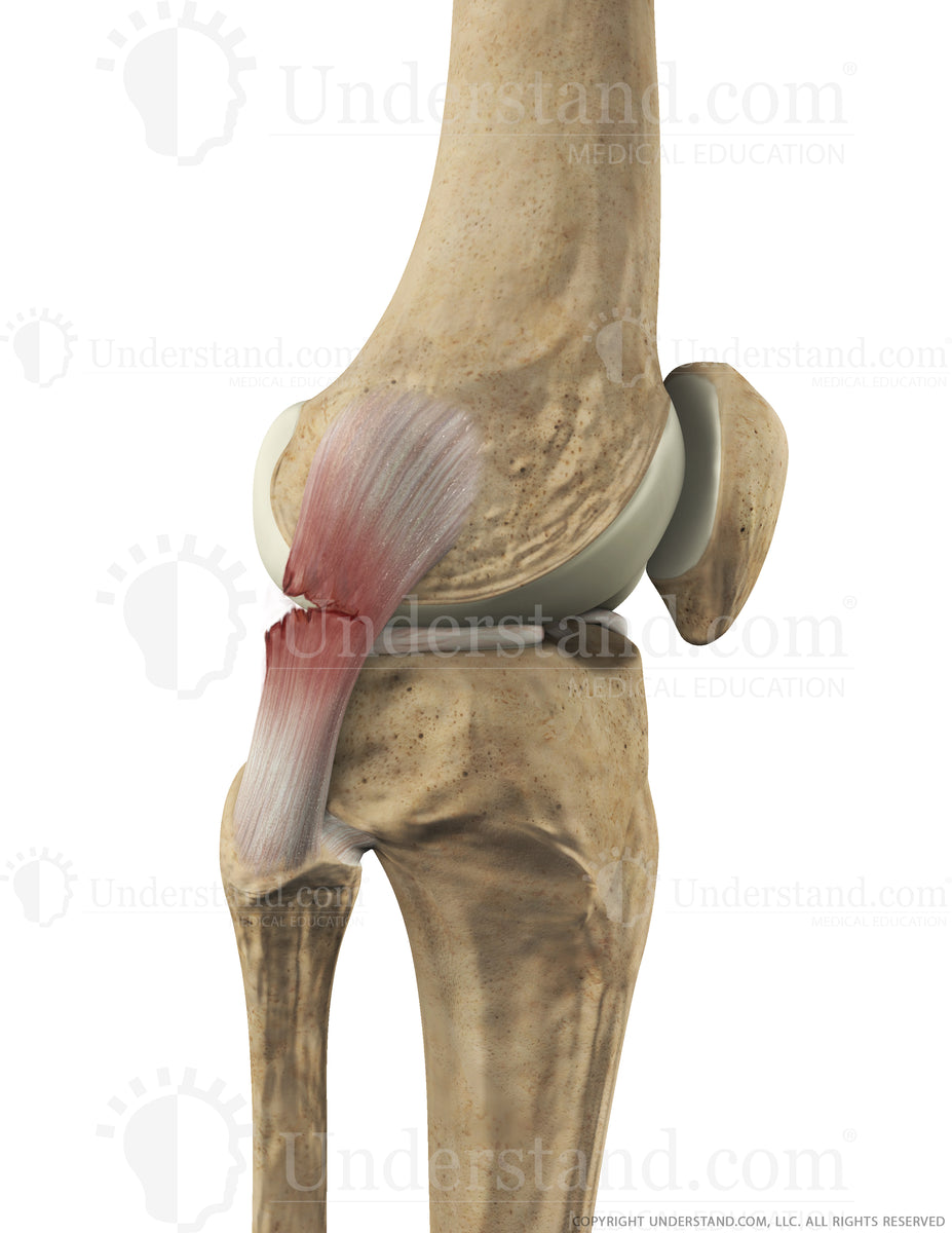 Torn LCL Lateral Extended Image – Understand.com