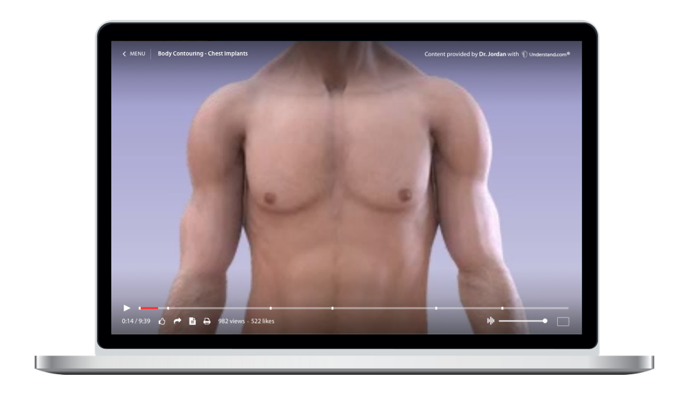 Body Contouring Implants - Chest (Pectoral) Animation – Understand.com