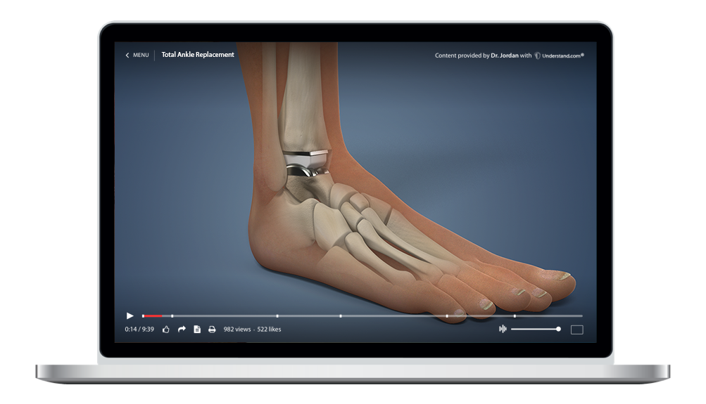 Total Ankle Replacement Animation – Understand.com