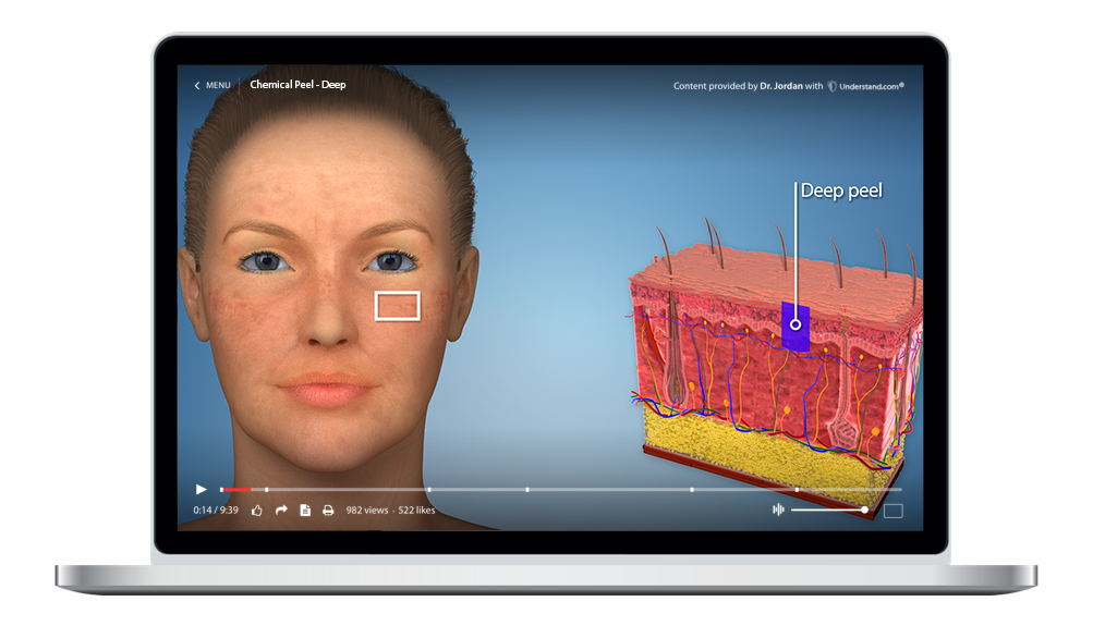 Chemical Peel - Deep Animation – Understand.com