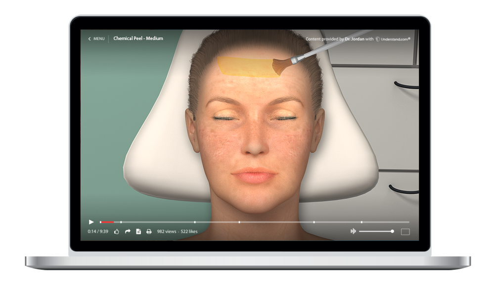 Chemical Peel - Medium Animation – Understand.com