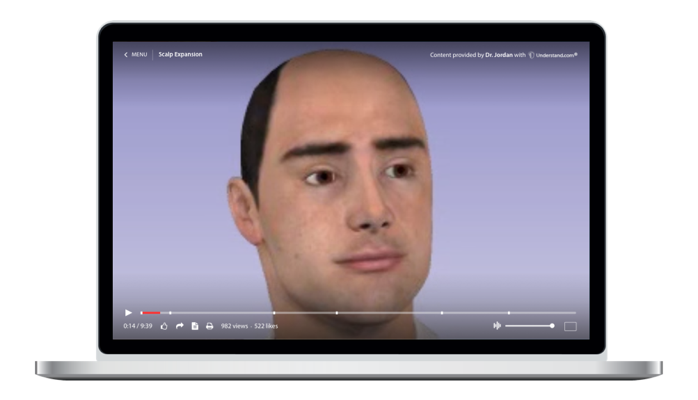 Scalp Expansion Animation – Understand.com