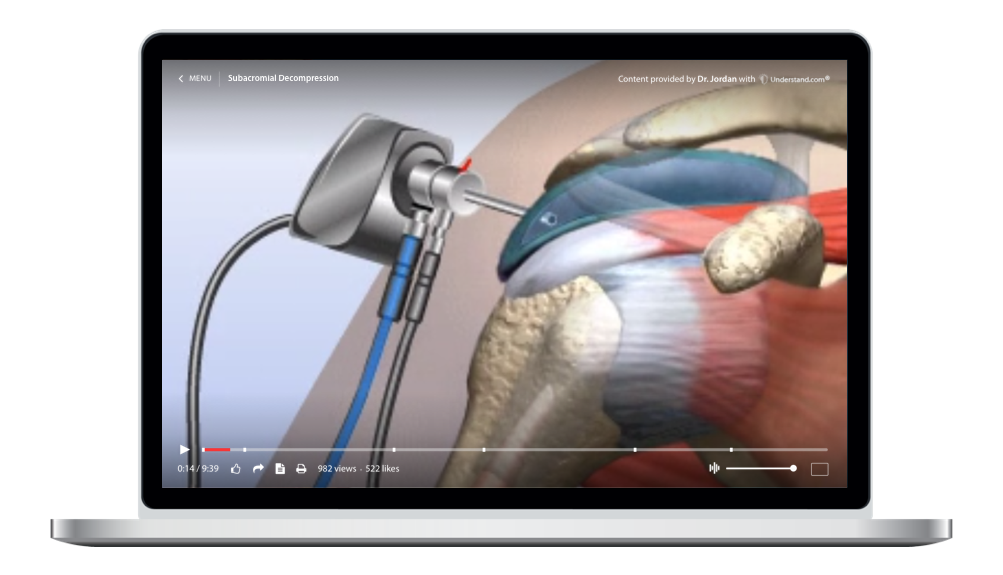 Subacromial Decompression Animation – Understand.com
