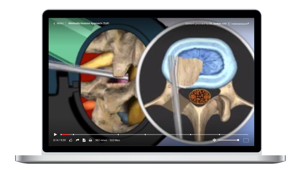 Lumbar - Minimally Invasive Approach (TLIF) Animation – Understand.com