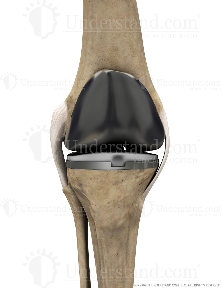 Total Knee Replacement Anterior Extended Image – Understand.com