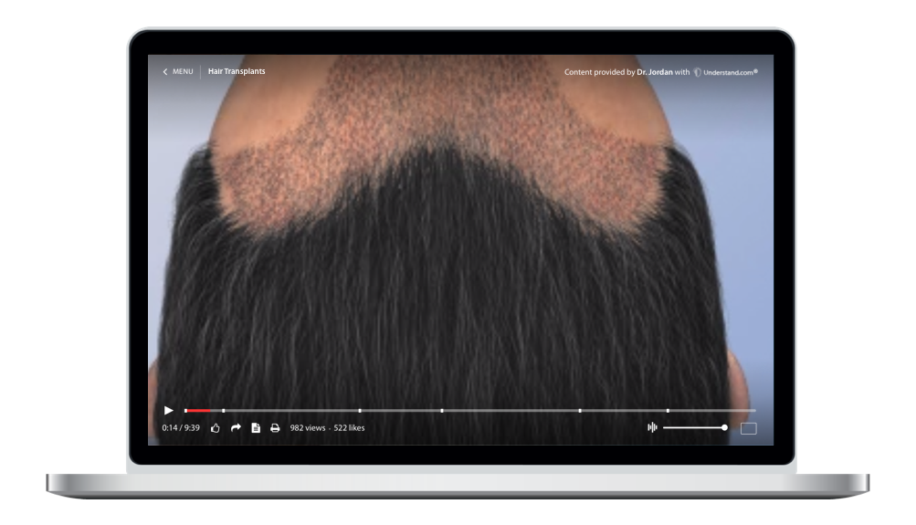 Hair Transplants Animation – Understand.com