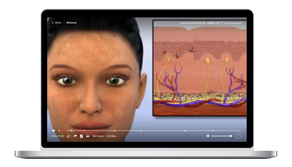 Melasma Animation – Understand.com