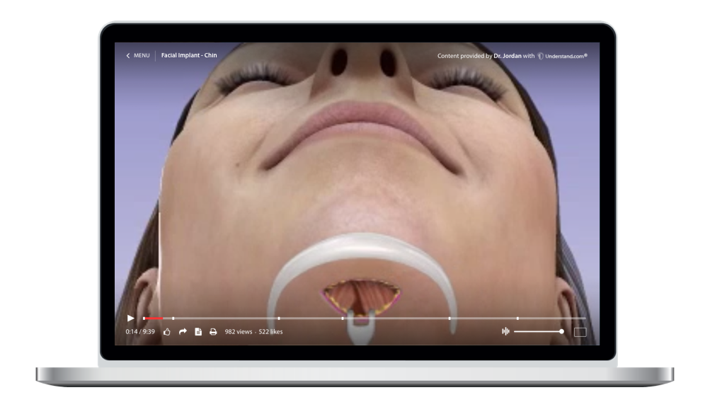 Facial Implants - Chin Animation – Understand.com