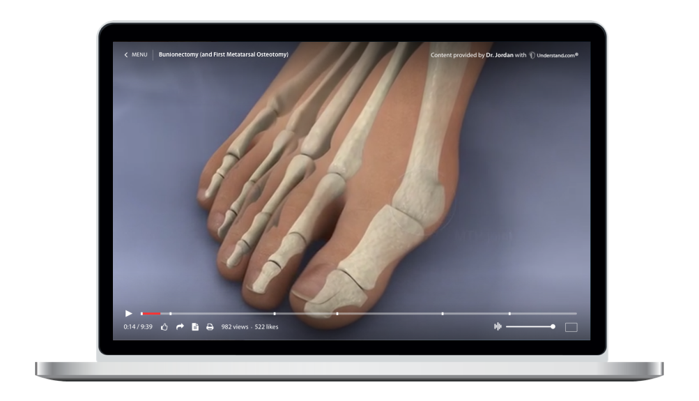 Bunionectomy (and First Metatarsal Osteotomy) Animation – Understand.com